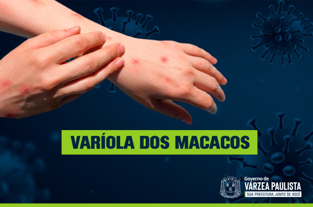Conheça os sintomas da varíola dos macacos e onde buscar atendimento em ...